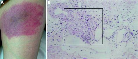 Eosinophilic Cellulitis Atypical Wells Syndrome Successfully Treated
