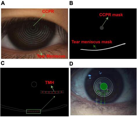 Ocular Surface Image Data A Original Ocular Surface Image B