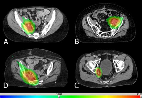Dosimetry For Pelvic Stereotactic Radiotherapy By Cyberknife For Each Download Scientific