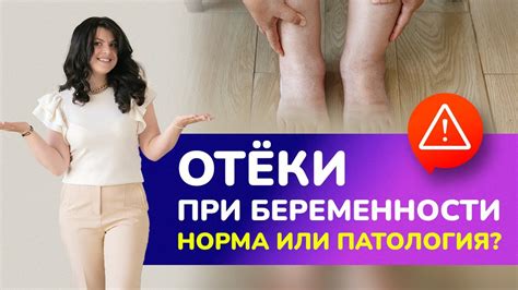Отеки при беременности: норма или патология? Как бороться с отеками ...