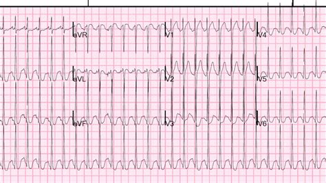 A 30 Something Agitated Male With A Regular Narrow Complex Tachycardia