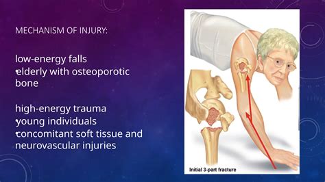Fracture Of Proximal Humerus Etiopathogenesis Clinical Features And