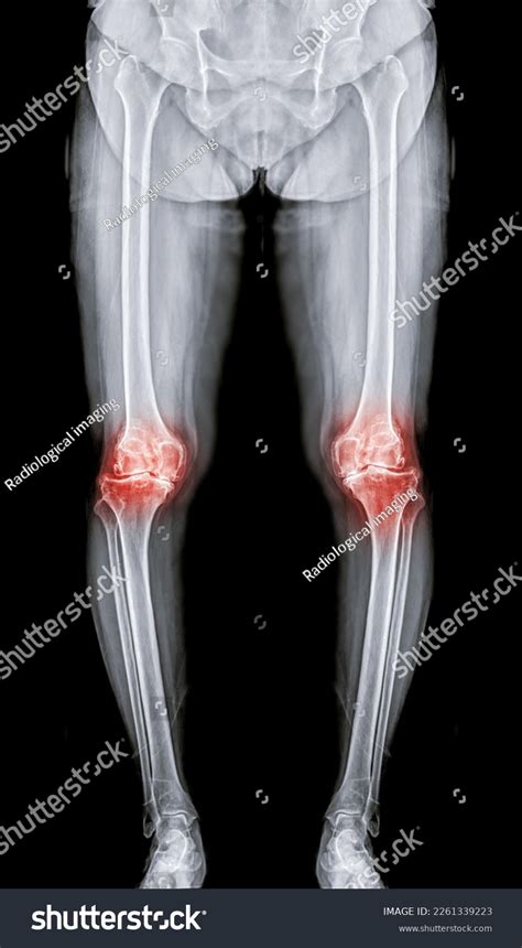 Scanogram Fulllength Standing Ap Radiograph Both Stock Illustration 2261339223 Shutterstock