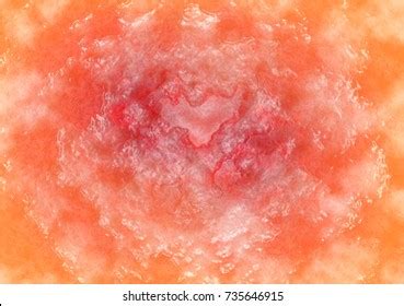 Skin Lesion Crusting Images Stock Photos Vectors Shutterstock