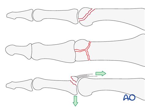 Dorsal Approaches To The Proximal Interphalangeal Joint