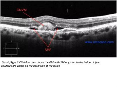Choroidal Neovascular Membranes Cnvm Pptx