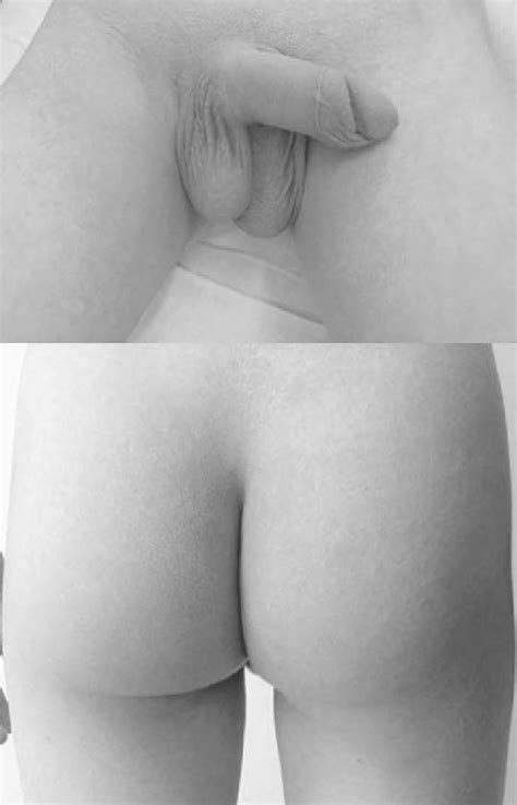 Symmetrically Distributed Rash On The Thighs And Inguinal Area And Download Scientific Diagram