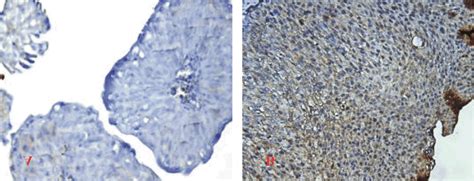 A Papillary Bladder Neoplasm Of Low Malignant Potential Showed