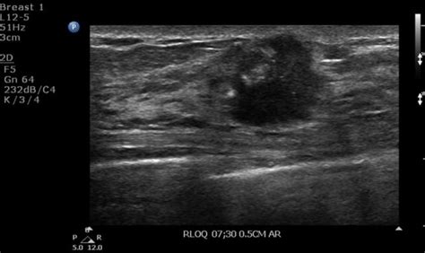 유방암검사 초음파사진 네이버 블로그