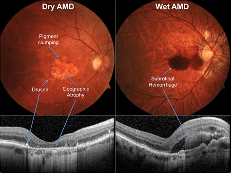 Wet Macular Degeneration