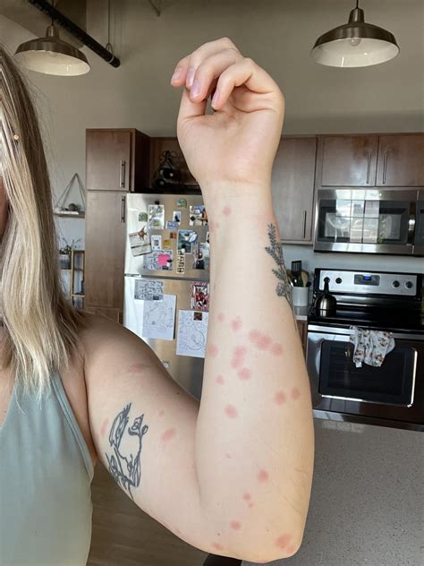 Do These Look Like Bed Bug Bites R Dermatologyquestions