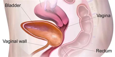 Cystocele ─ Causes Advices And Treatment Mmt Hospital