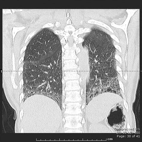 Scleroderma A Focus On Pulmonary Findings Eurorad