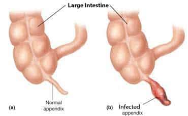 Burst Appendix Symptoms