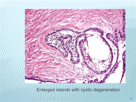 Odontogenic Tumor 2022pptx Dental Health Diseases And Conditions