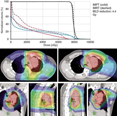 Principles Of Intensity Modulated Proton Therapy Treatment Planning Clinical Tree