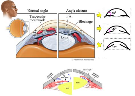 Narrow Angle Eye Condition
