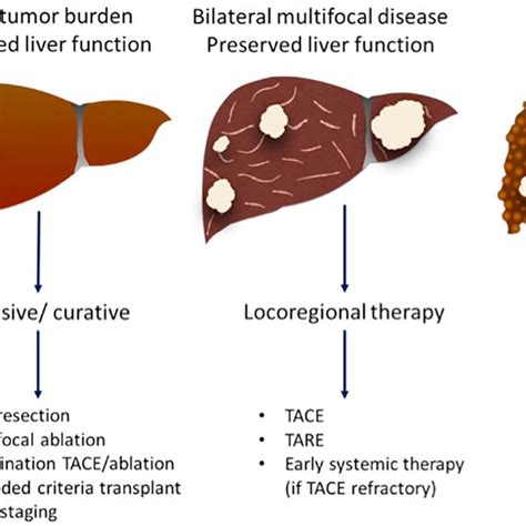 Clinical Spectrum Of Intermediate Stage Hcc Hcc Hepatocellular