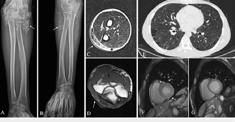 Systemic Involvement Of Scleromyositis A And B Extensive Calcinosis Of Download Scientific