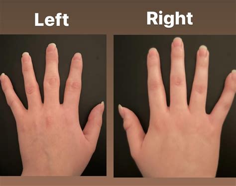 Does This Look Like Scleroderma R Scleroderma