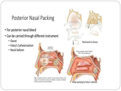 Adult Epistaxis Etiology And Management Pptx