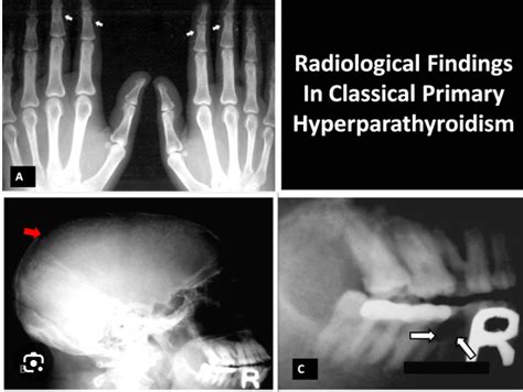 Understanding The Link Between Recurrent Fractures And Hyperparathyroidism
