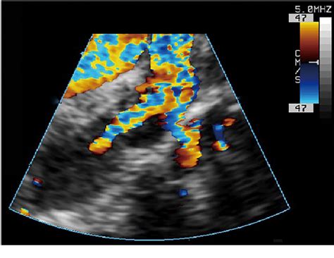 Figure 2 From Transventricular Valvotomy For Pulmonary Atresia With