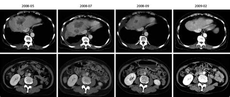 Figure 1 From A Case Of Advanced Intrahepatic Cholangiocarcinoma
