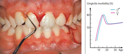 Hormonally Modulated Gingivitis Pocket Dentistry