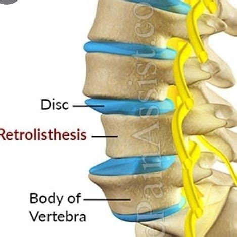 Retrolisthesis