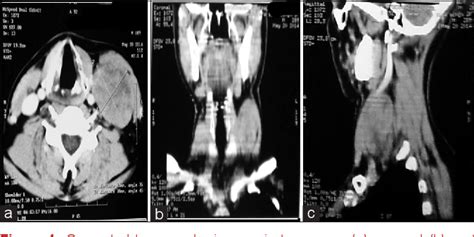 Figure 1 From Primary Extraskeletal Peripheral Primitive Neuroectodermal Tumor Of Subcutaneous