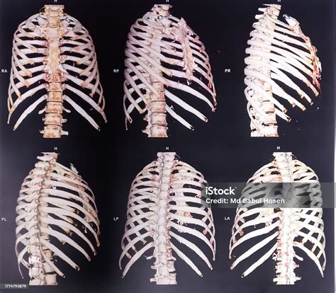3d Ct Scan Bony Thorax Multiple Fractures Are Present Sternal Bone Fractures With Bilateral