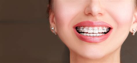 Achieve A Confident Smile With Damon Braces In Reno This Winter South Meadows Dental
