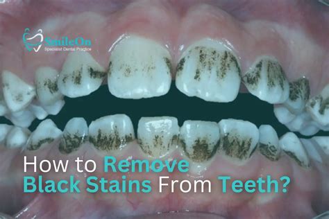 Black Stains On Teeth How To Remove Detroit Chinatown