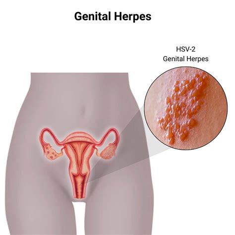Genital Herpes Treatment Midtown Nyc And Rego Park Queens Best