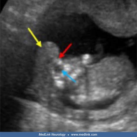 Anencephaly And Other Neural Tube Defects Medlink Neurology