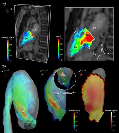 4 Cardiovascular In Vivo Fluid Dynamics A Lv Diastolic Filling In A Download Scientific