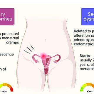 Main differences between primary and secondary dysmenorrhea. | Download Scientific Diagram