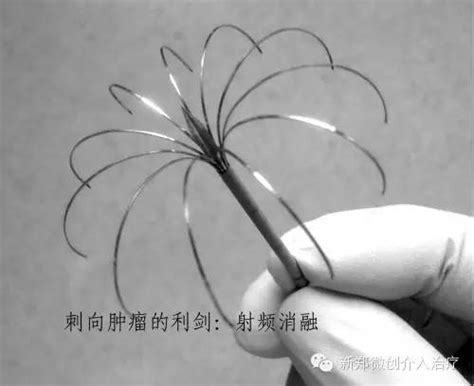 肺癌患者还有射频消融（rfa）治疗可以选择百科ta说