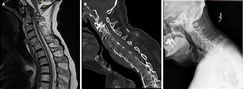Anterior C1 C2 Pannus Clinical Tree