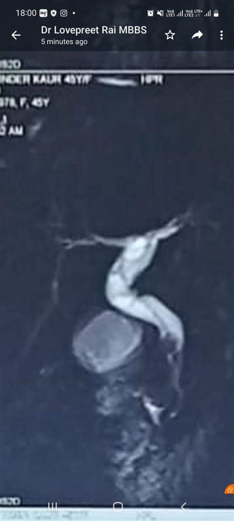 Case Of A Lady Who Had Failed Ercp With A Large Cbd Stone Removed