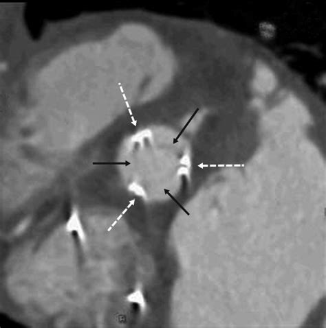 Ecg Gated Mdct After Aortic And Mitral Valve Surgery Ajr