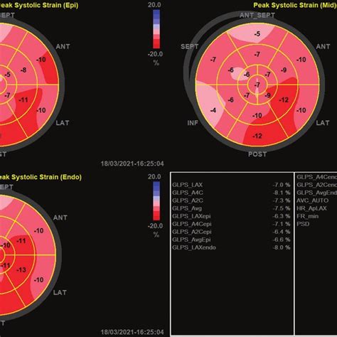Left Ventricular Global Longitudinal Layer Strain Analysis Of A Patient Download Scientific
