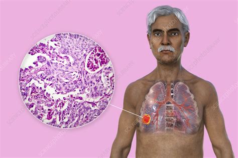 Lungs Affected By Lung Cancer Illustration Stock Image F0386514