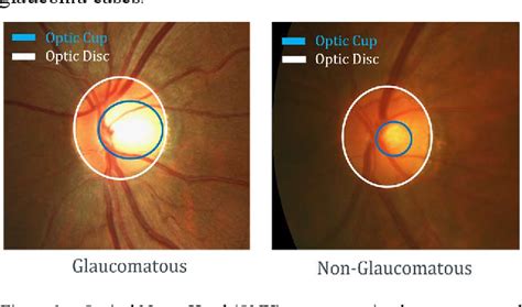 Figure 1 From Optic Disc And Optic Cup Segmentation On Retinal Image Based On Multimap
