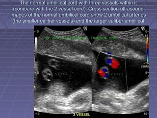 Amniotic Fluid Ultrasound Ppt