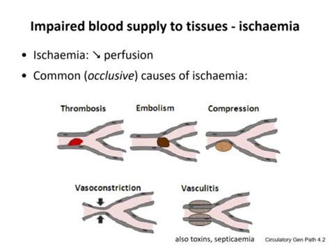 Infarction Ischaemia Hypoperfusion Shock Flashcards Quizlet