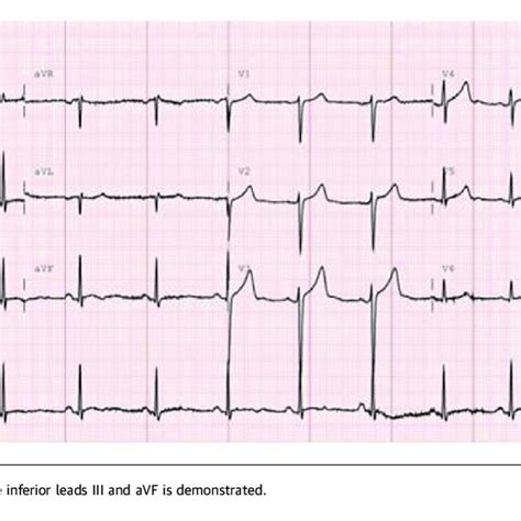 12 Lead Electrocardiogram Patient 2 Download Scientific Diagram