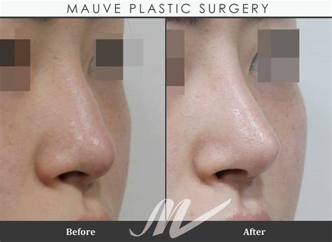 이다희 코라인이 갖고 싶어요 코필러후 코라인 개선 사례 코성형콧대코끝이마필러 성형외과 전문의 칼럼 코성형 가슴성형 수술 사례 오똑한 콧날 낮은코 짧은 코끝