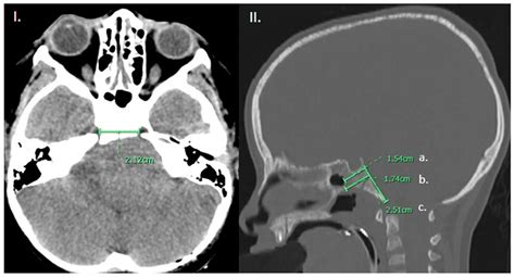 Positioning Transclival Tumor Treating Fields For The Treatment Of